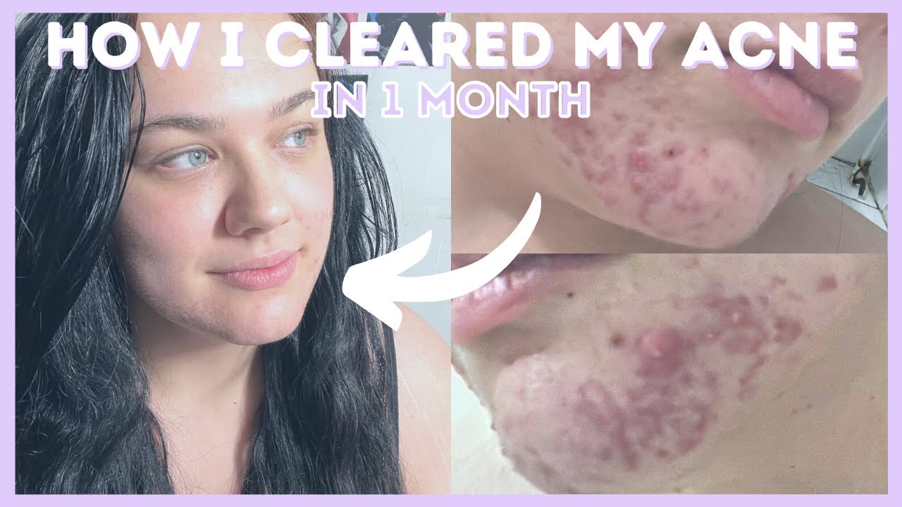 My Cheap & Affordable Skincare Regimen That Cleared My Acne In 1 Month ...