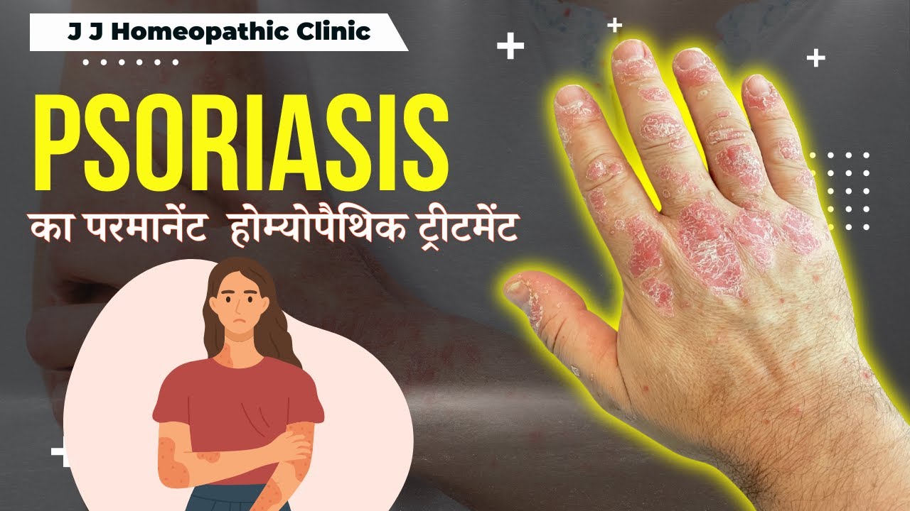 सोरायसिस का इलाज | Psoriasis Permanent Treatment with Homeopathy ...