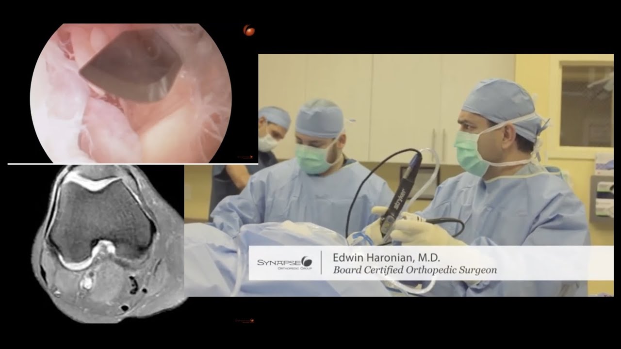 Knee Surgery for a Meniscus Tear - YouTube