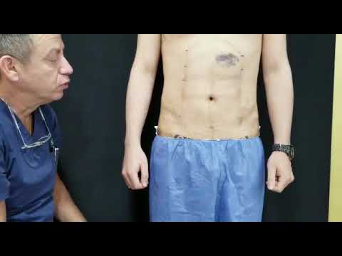 Liposuccion y Marcación Abdominal - YouTube