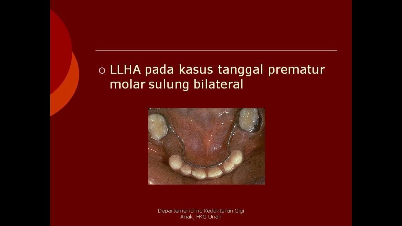 Perawatan Tanggal Prematur pada Gigi Sulung dan Perencanaan Space ...