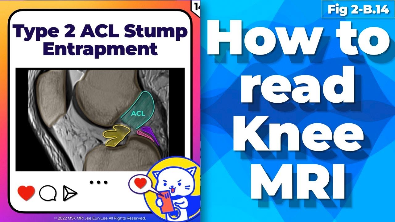 (Fig 2-B.14) Type 2 ACL stump entrapment Lesion - YouTube