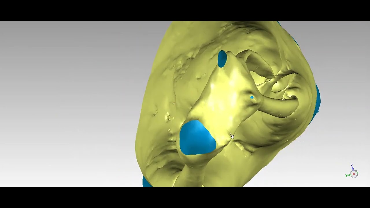 Atlas anatomía dental 3D. Anatomía del sistema de conductos diente 1.6 ...