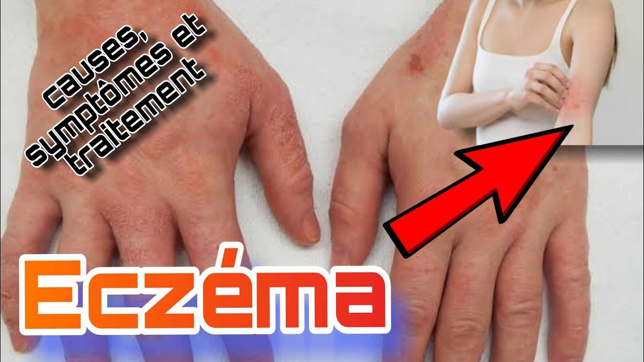 Eczéma - Qu'est ce que l'eczéma ? - YouTube