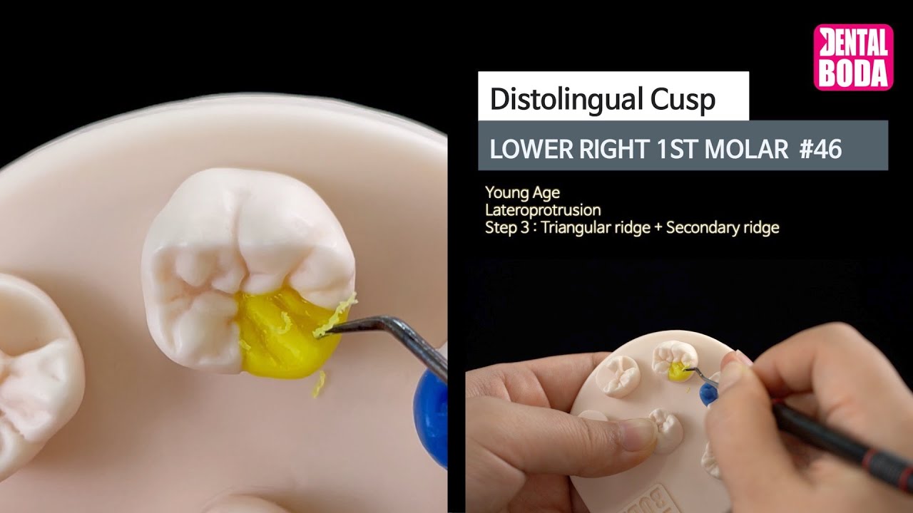 Lower Right 1st Molar distolingual cusp 3 ridge (young-aged) Wax-Up #46 ...