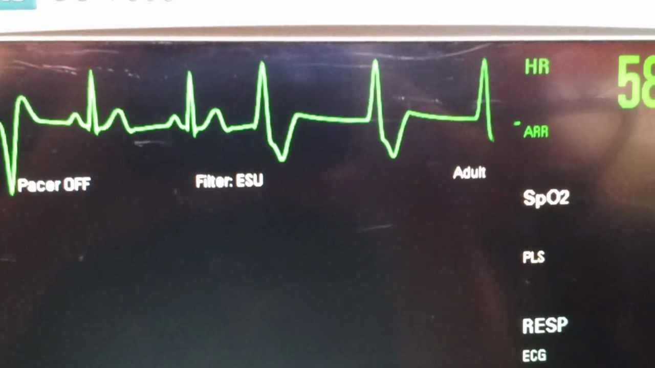 Simulated waveforms from patient simulator - YouTube