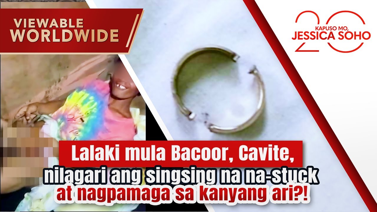 Lalaki, nilagari ang singsing na na-stuck at nagpamaga sa kanyang ari ...