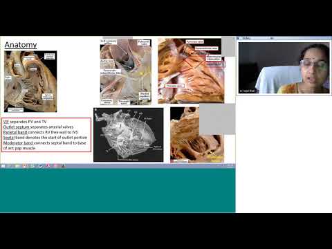 VSD diagnosis and medical management  by Dr Sejal Shah