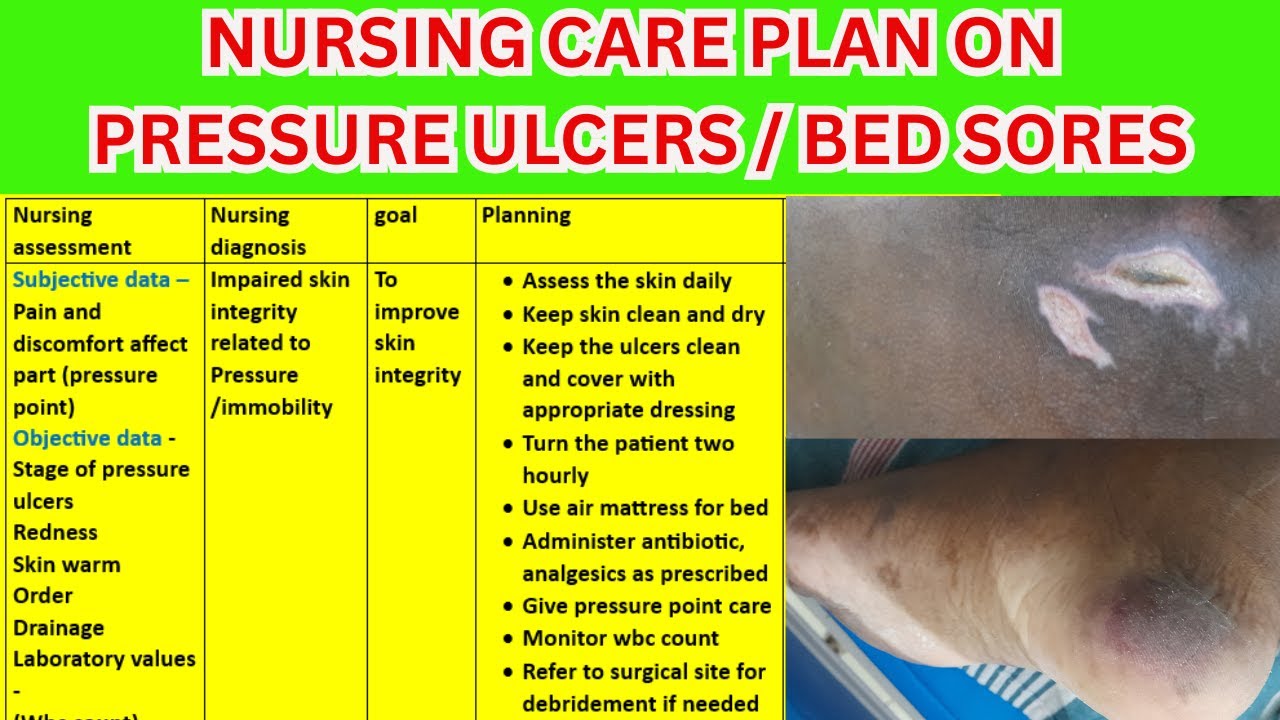 Care Plan on pressure ulcers | nursing care plan on bed sores - YouTube