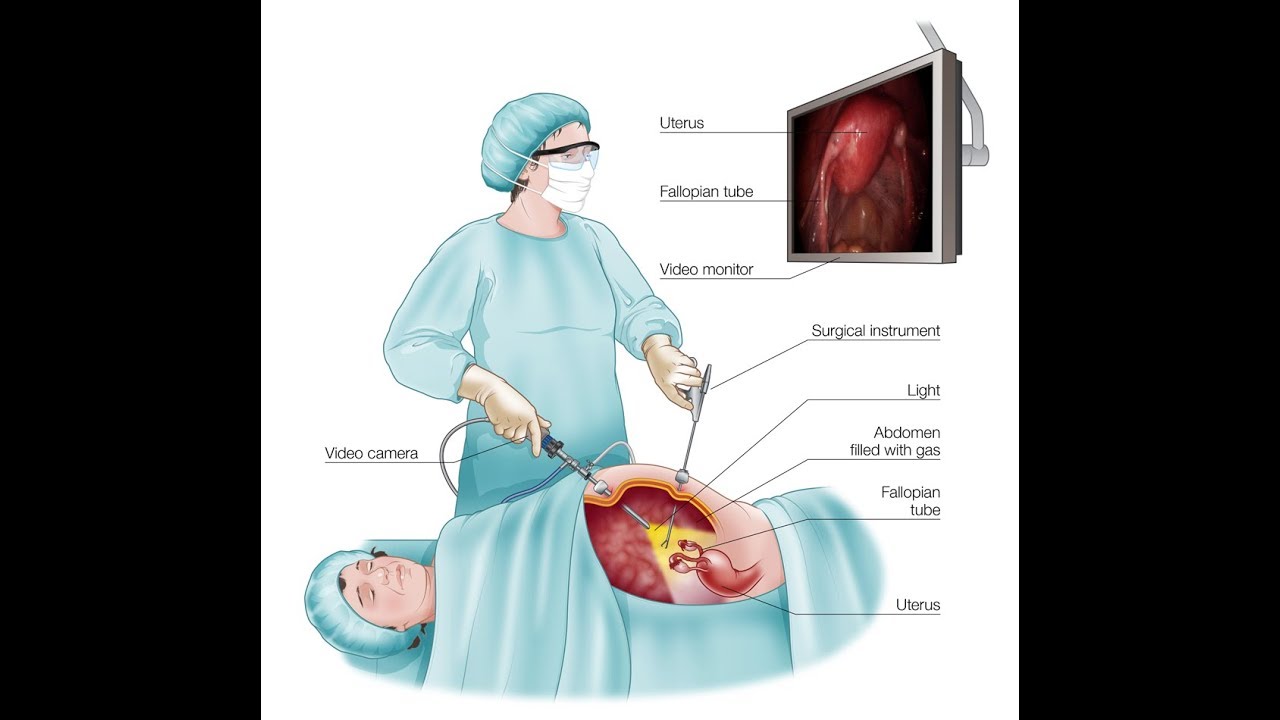 Laparoscopy and Hysteroscopy Sergery of women - YouTube