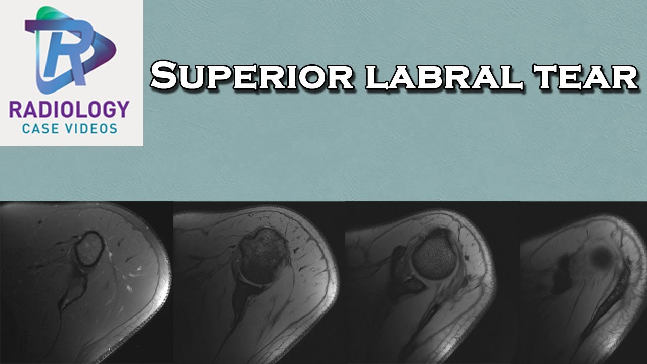 Superior labral tear - YouTube