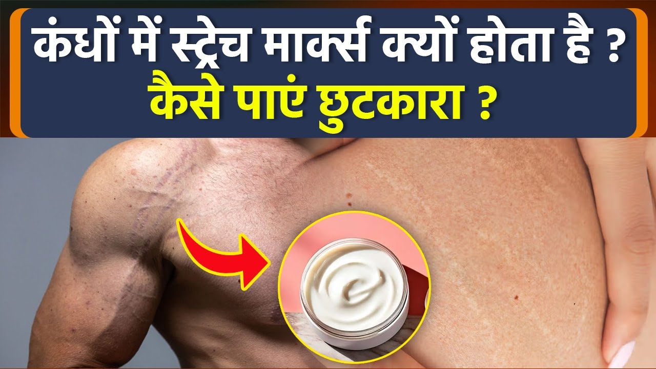 Stretch Marks At Shoulder:कंधों में स्ट्रेच मार्क्स क्यों होता है,कैसे ...