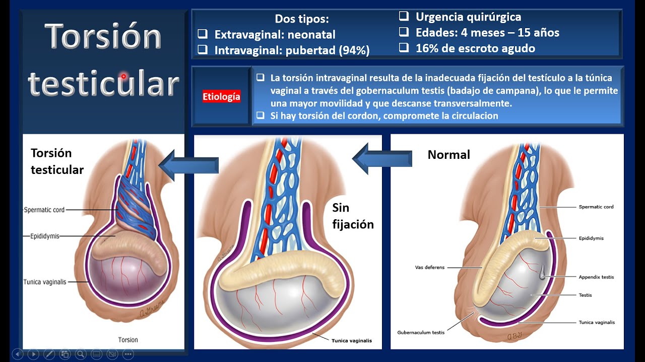 Escroto Agudo Torsión Testicular Vs Torsión De Apéndice Vs