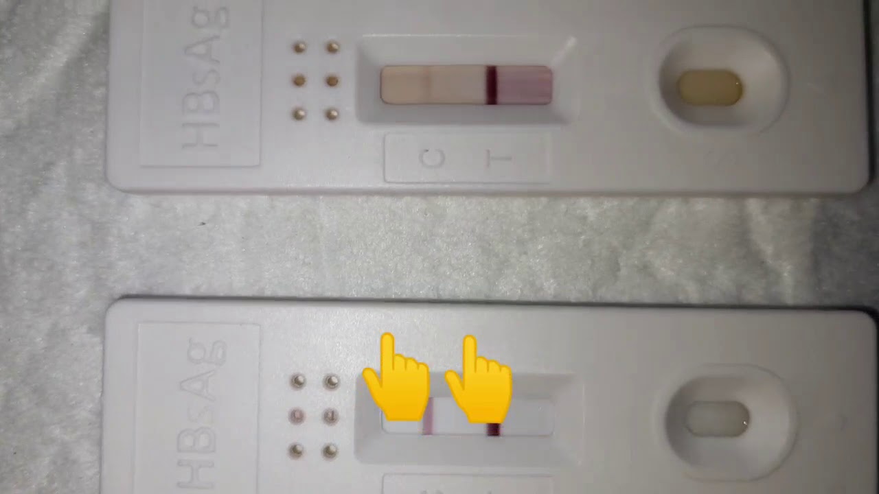 Analisis Uji HBsAg dugaan Titer Sangat Tinggi Edukasi bagi ATLM - YouTube