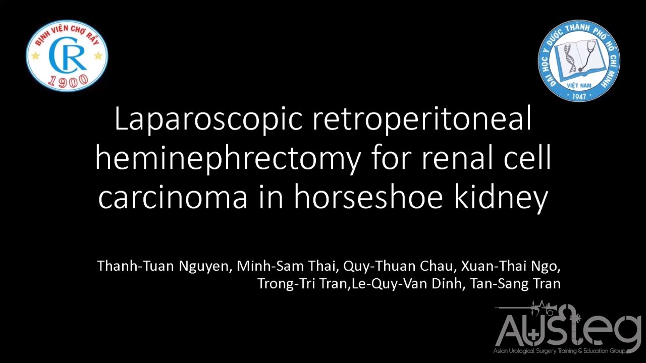 Laparoscopic Retroperitoneal Heminephrectomy for Renal Cell Carcinoma in Horseshoe Kidney - YouTube