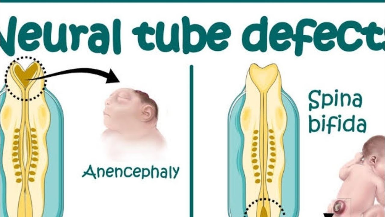 neural tube defect - YouTube