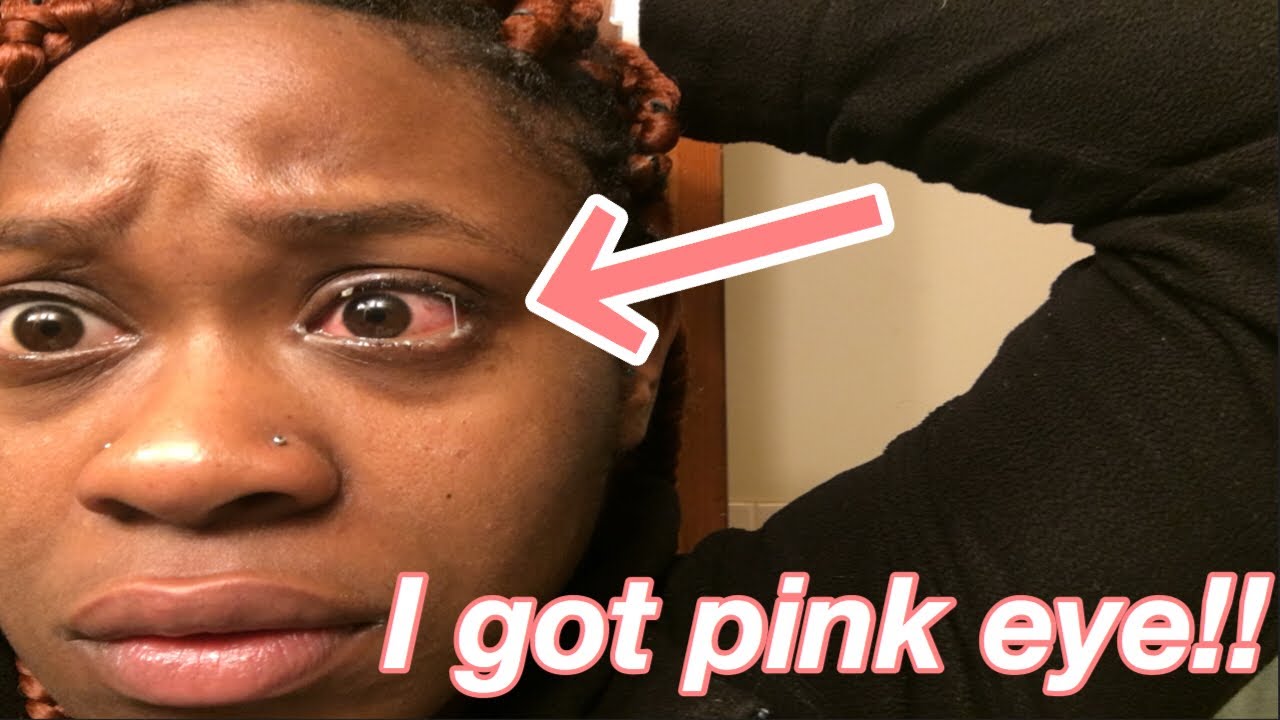 I got pink eye!!! 😣 (how to know when you have it) - YouTube