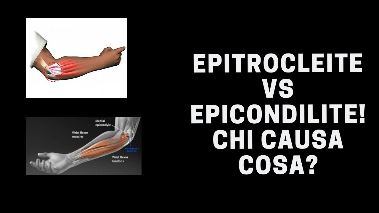 EPICONDILITE ED EPITROCLEITE: COSA E' PIU' FREQUENTE? - YouTube
