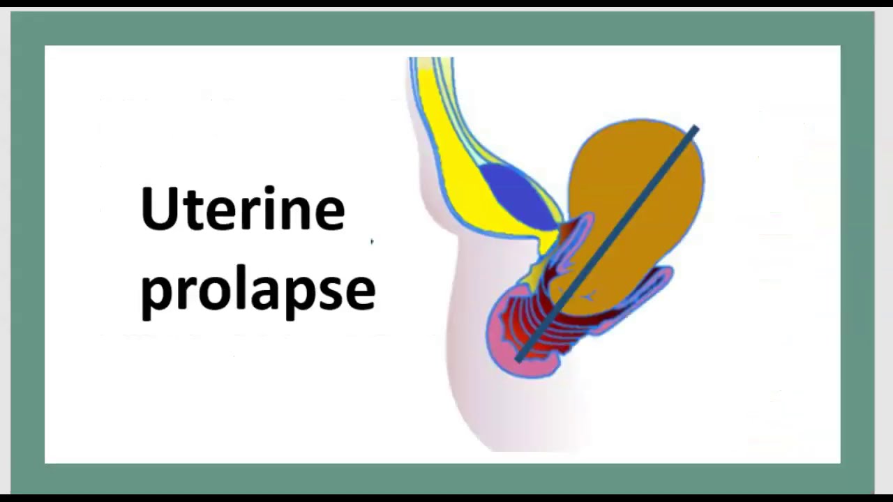 3 Minutes Pelvic Organ Prolapse Causes Kegel Exercises Cystocele