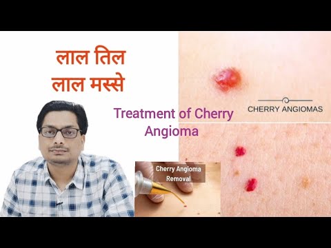 Cherry Angioma | Cherry Hemangioma | लाल तिल | लाल मस्से | lal til ka ...
