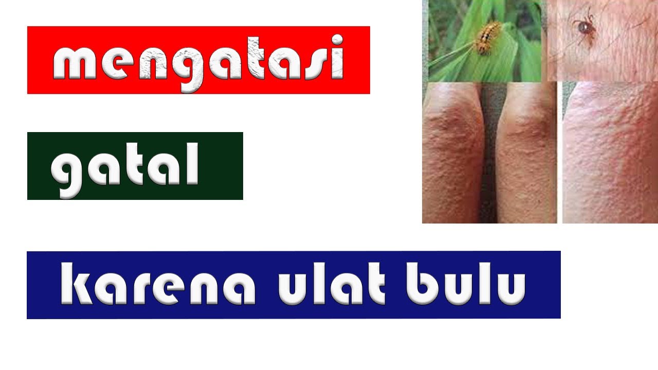 CARA MENGATASI GATAL KARENA ULAT BULU - YouTube