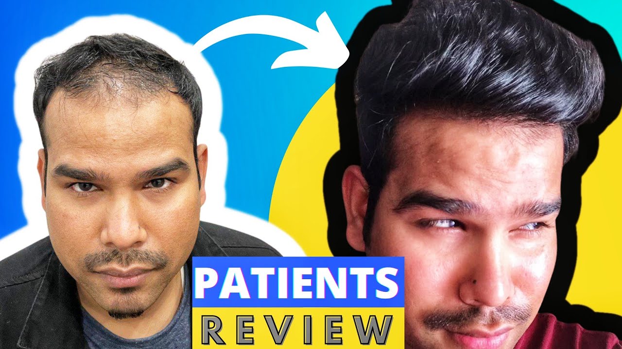 A True Bald To Bold Transformation By Dr. Santosh Modi | Hair ...