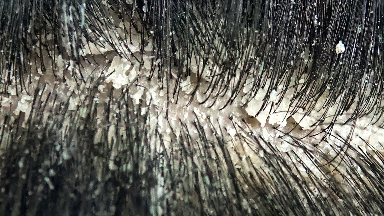 Best Dandruff Scratching On Scalp!! Huge Dandruff Flakes Removal - YouTube