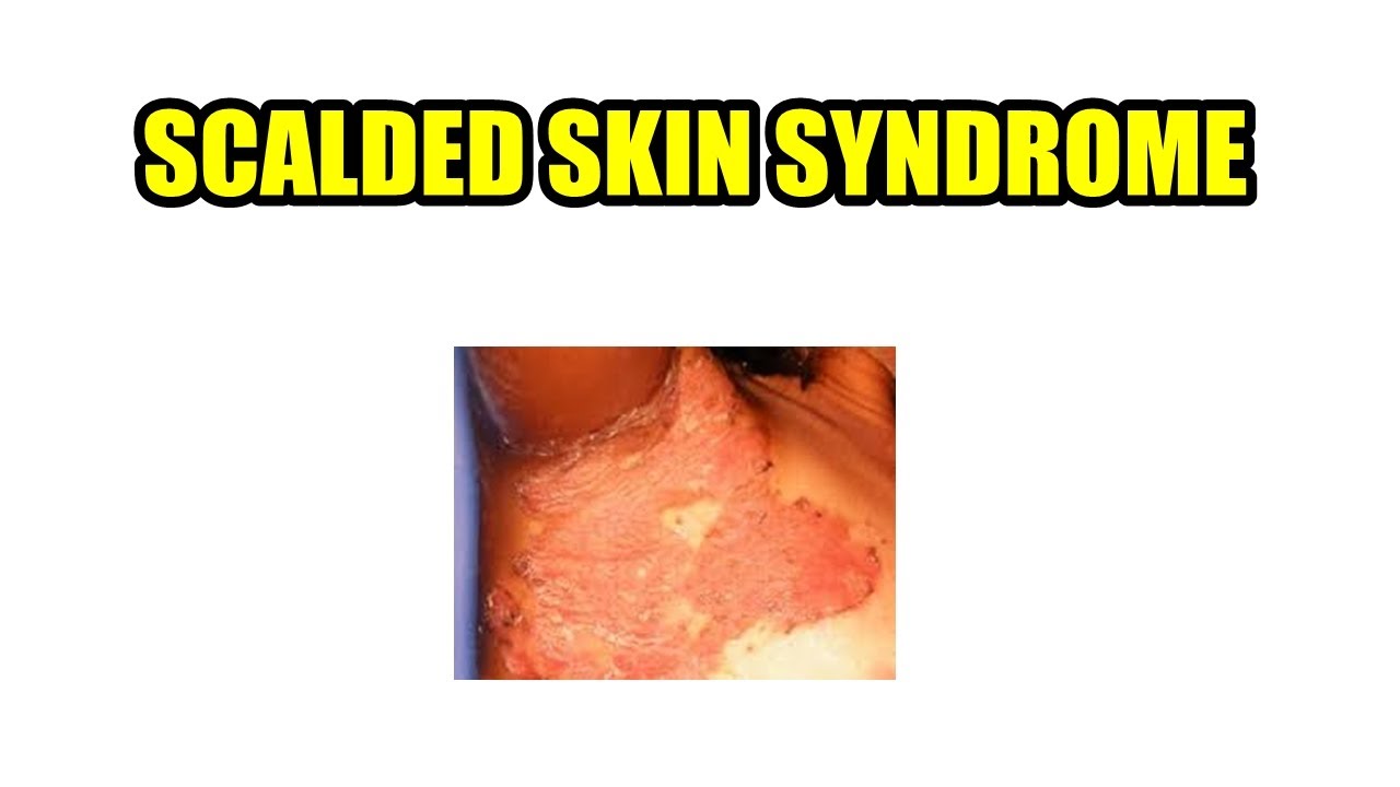 Scalded Skin Syndrome in 1 minute - YouTube