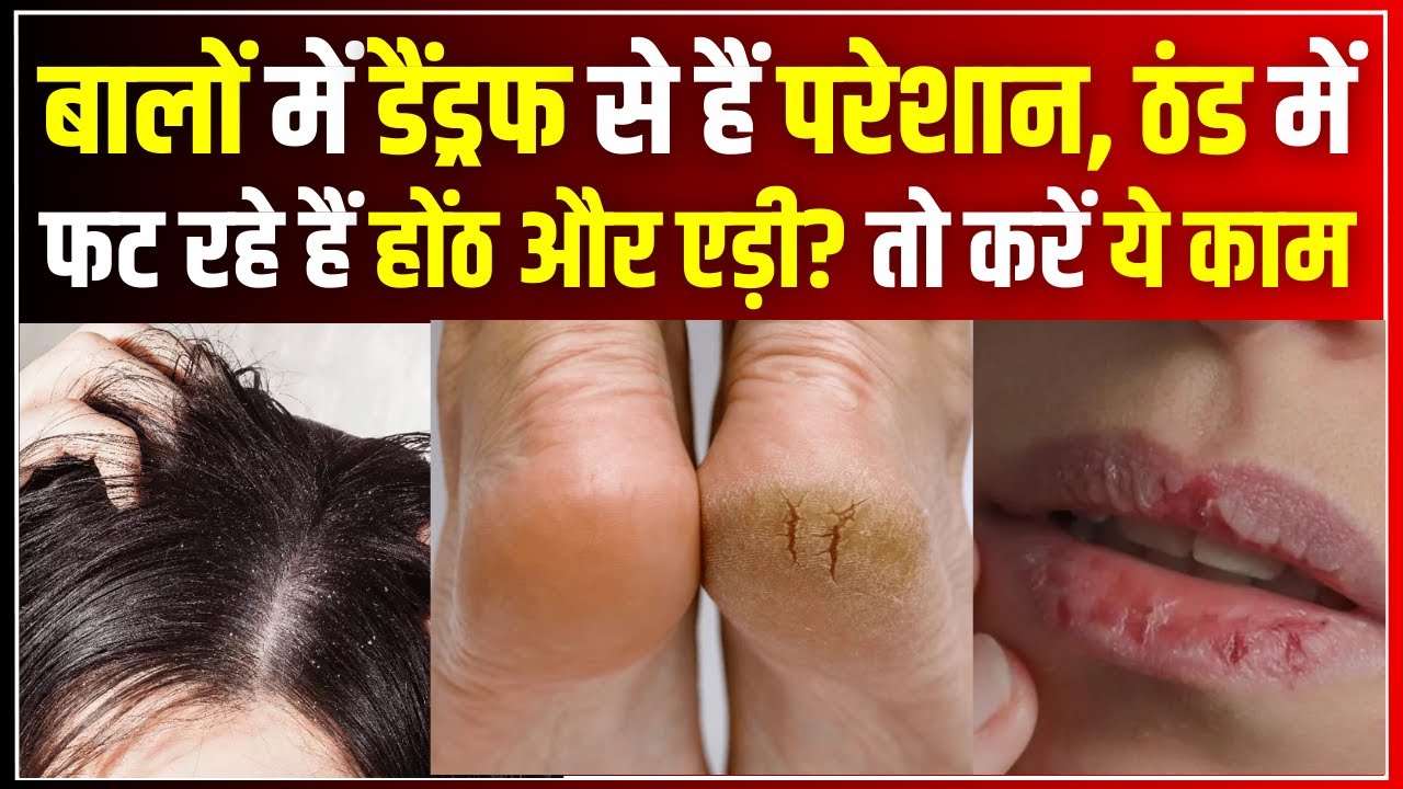 Home Remedies Hair में डैंड्रफ से हैं परेशान फट रहे हैं होंठ तो सोने