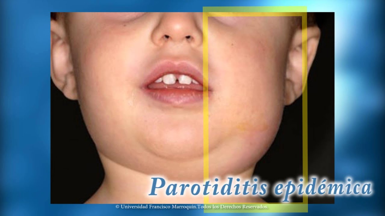 Parotiditis 2 - YouTube