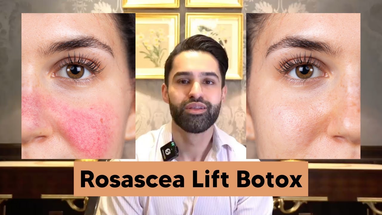 Benefits of Rosacea Botox - YouTube