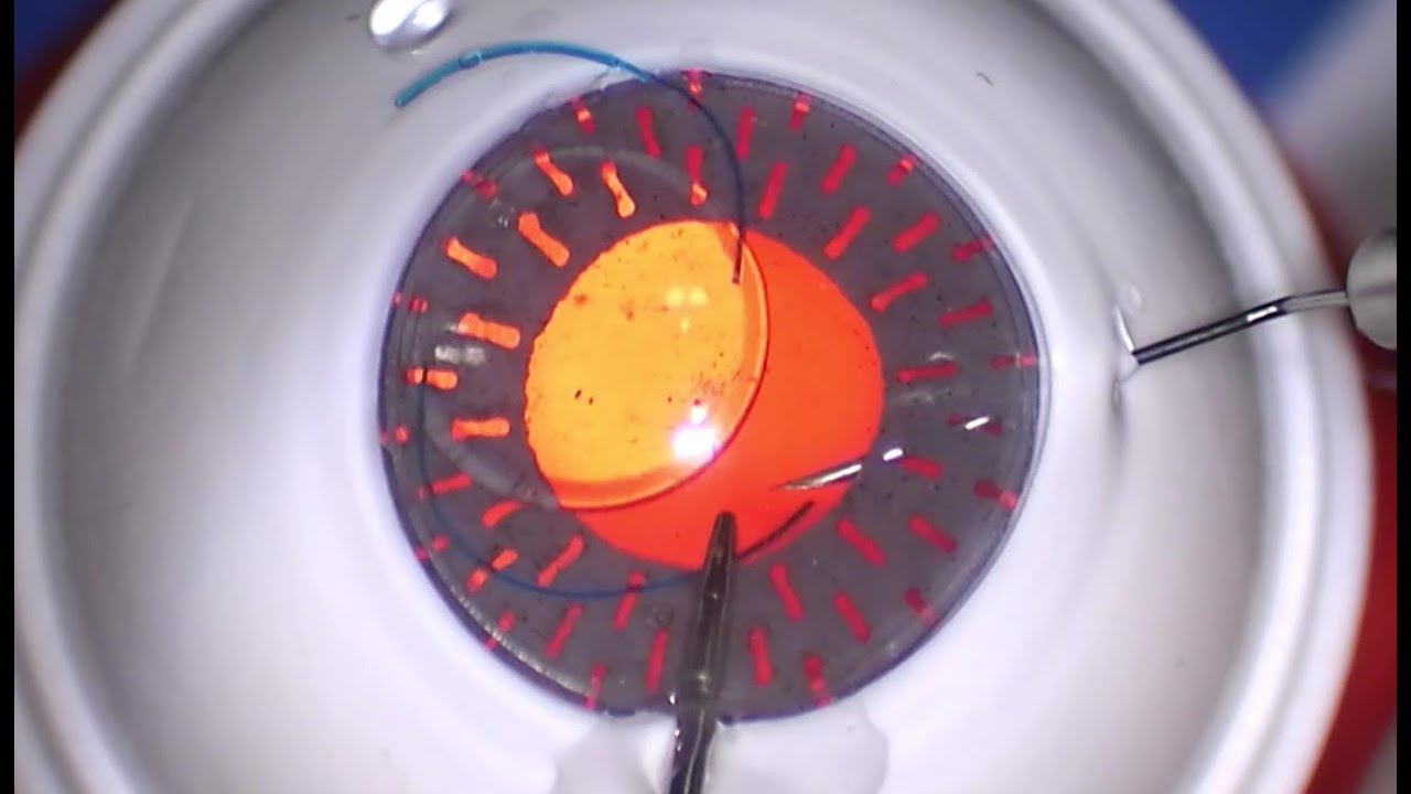 SimulEYE ISHF Model: Kim Modified Yamane Technique, JnJ Sensar. Gentle ...