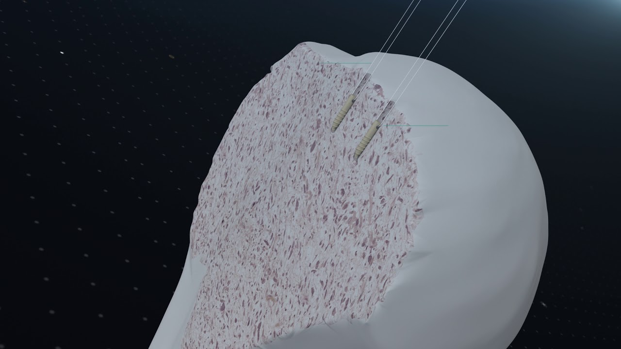 SIRONIX ALL SUTURE LOOP ANCHOR - YouTube