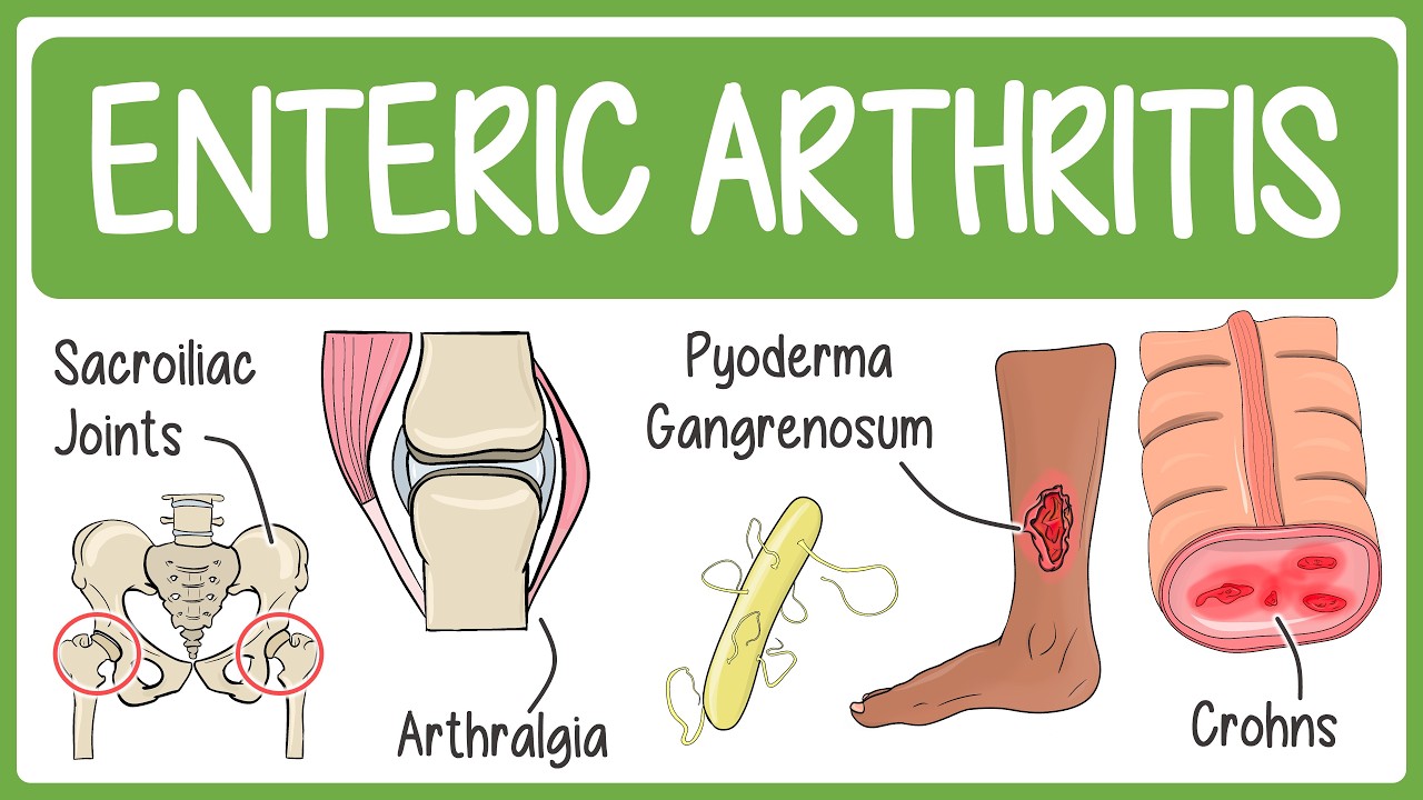 Enteric Arthritis Visually Explained - YouTube