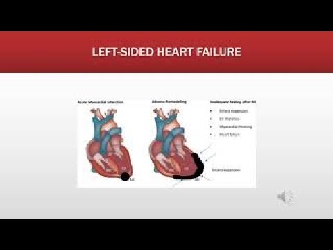 Left Sided Heart Failure: What you Need To Know As A Patient - YouTube