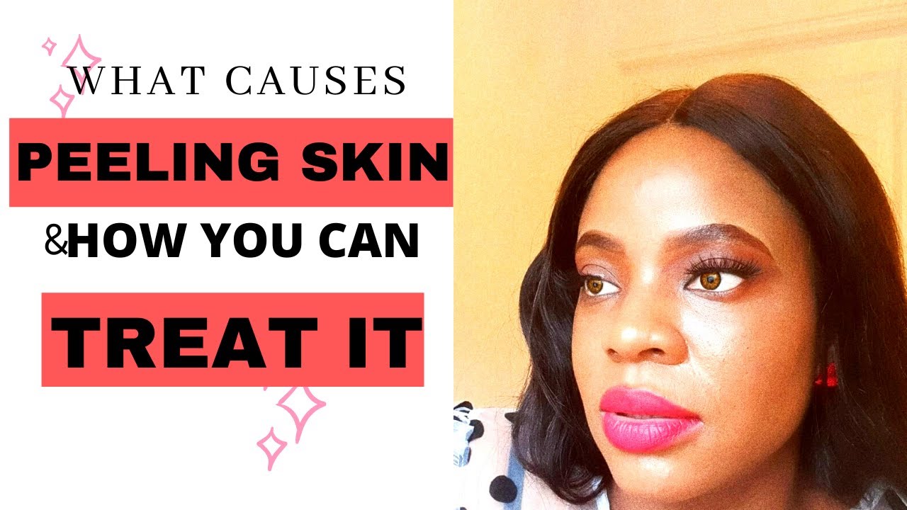 WHAT YOU SHOULD KNOW IF YOUR SKIN IS PEELING ALL SKIN TYPE - YouTube