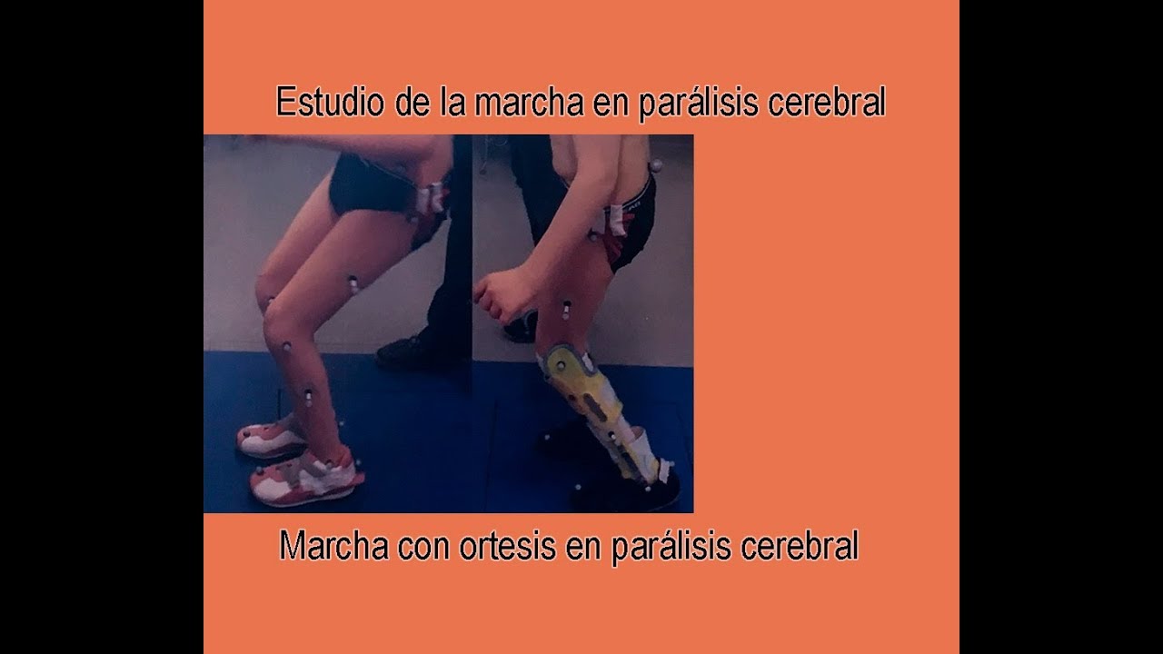 PARALISIS CEREBRAL: Estudio de la marcha y marcha con ortesis - YouTube