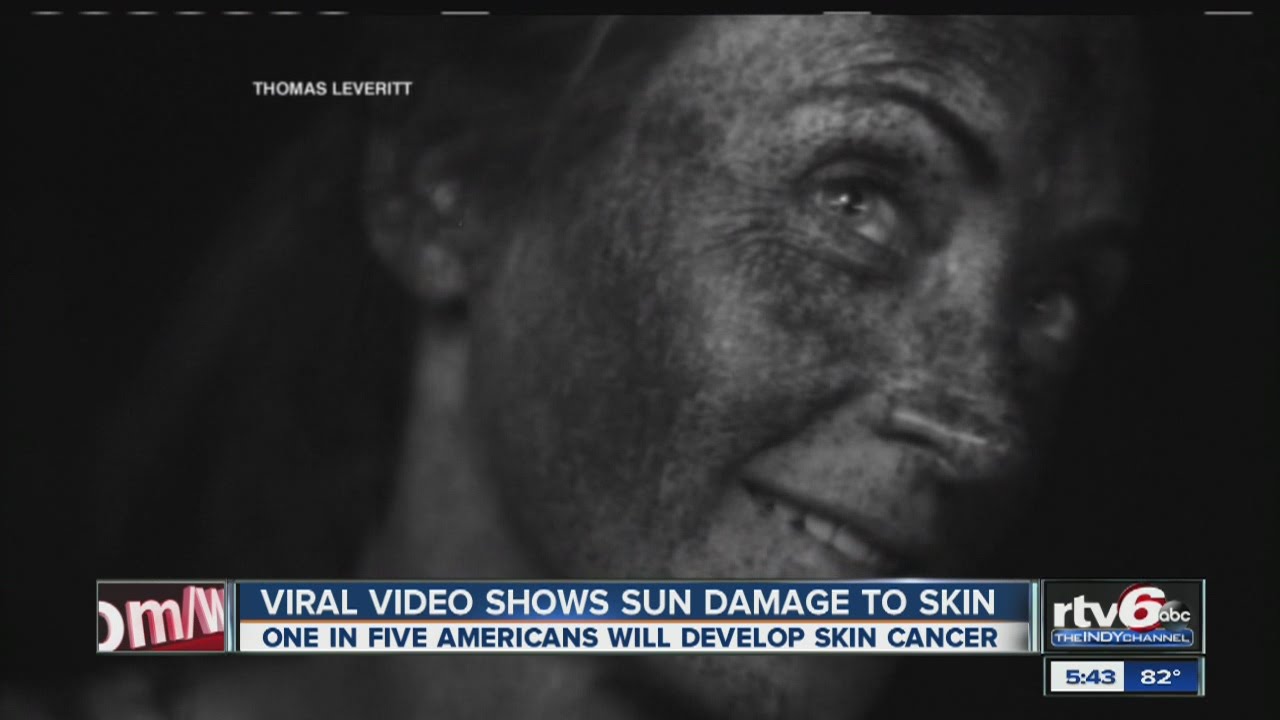Video: UV camera shows harsh realities of sun damage - YouTube