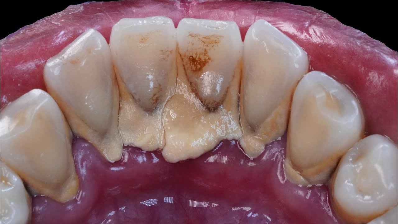 37yo. Female. SCALING - TARTAR - CALCULUS | Dentist | Dokter Gigi Tri ...