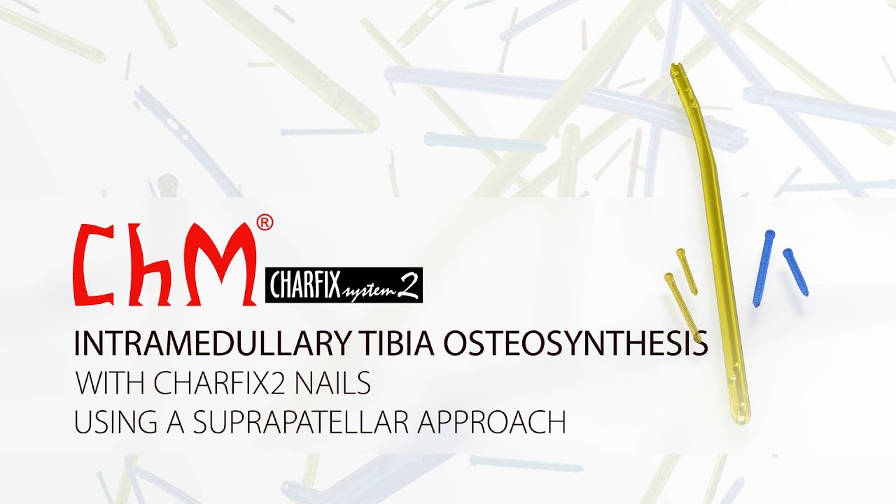 Intramedullary tibia osteosynthesis with CHARFIX2 nails using a ...