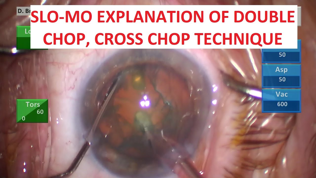 TBWTDCS #156: 3-4+ Dense Lens, Slo-Mo Explanation of Double Chop, Cross ...