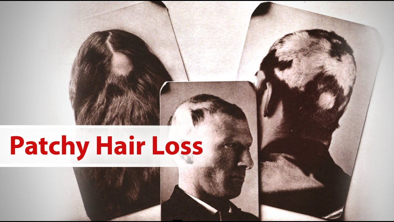 5 Tips for Patchy Hair Loss - YouTube