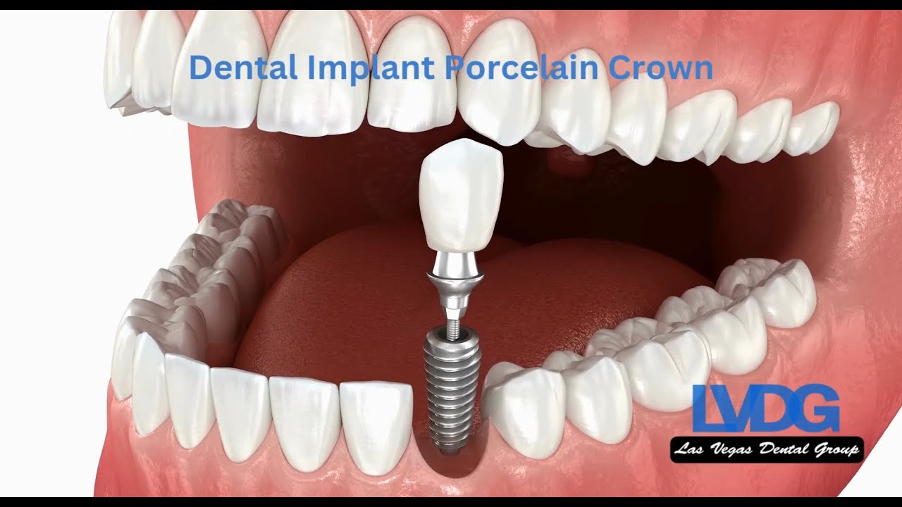 Dental Implant Porcelain Crown Animation | Dental Implant Dentist Las ...
