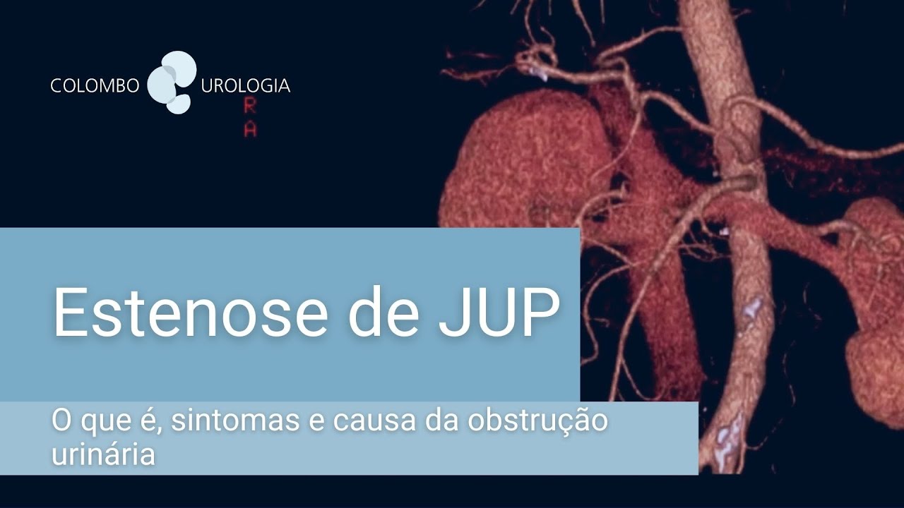 Estenose de JUP: O que é, sintomas e causas da obstrução urinária - Dr ...