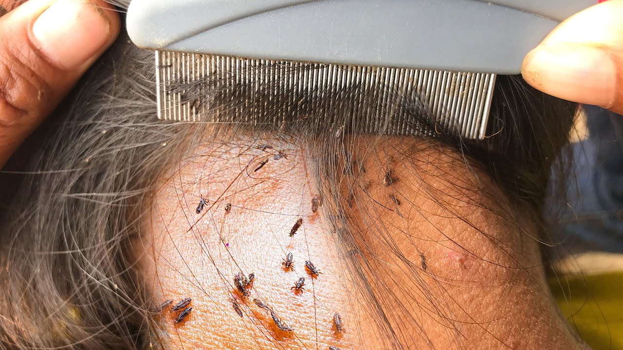 Removing Thousand of Lice From Head Using Comb And Taking All Lice out ...