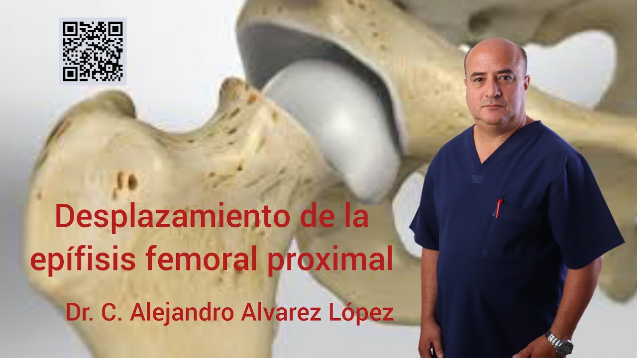 Desplazamiento de la epífisis femoral proximal - YouTube