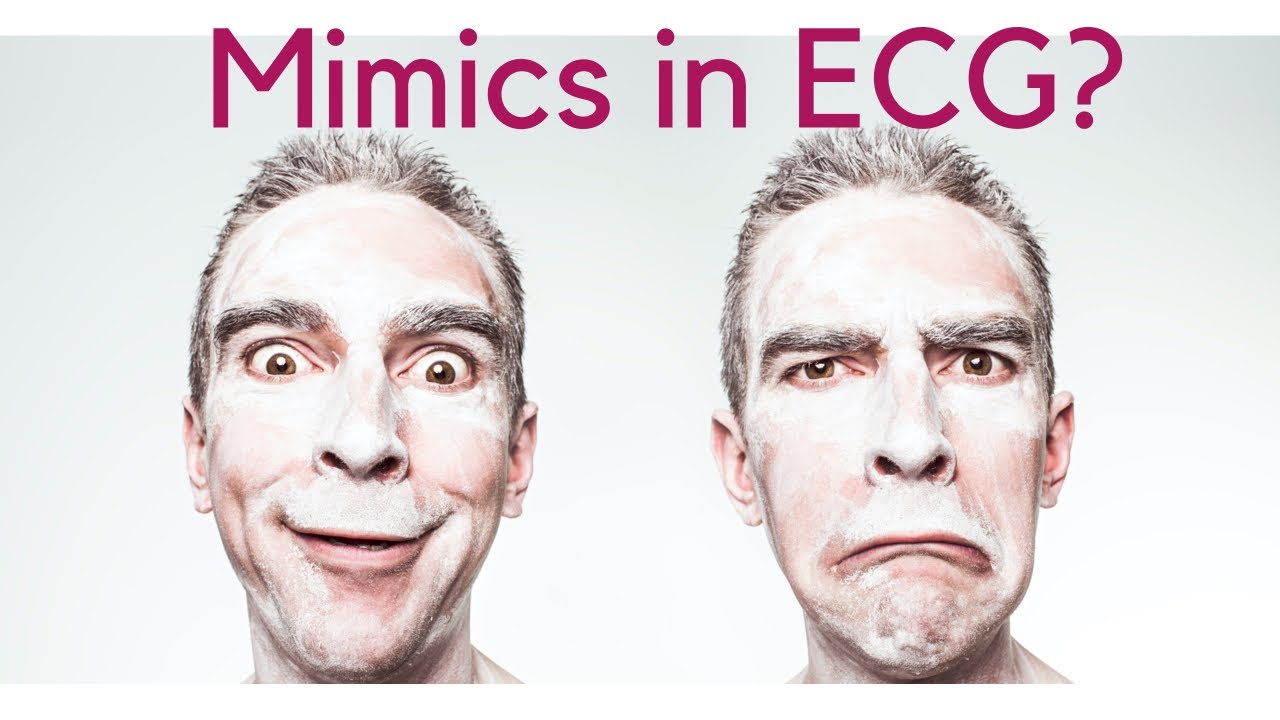 ECG BnB - MIMICS IN ECG - YouTube