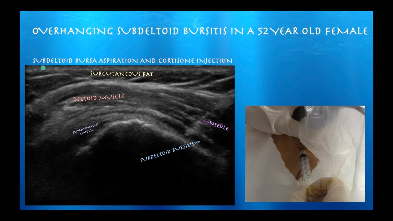 Ultrasound guided Subacromial Injection of an Overhanding Subdeltoid ...