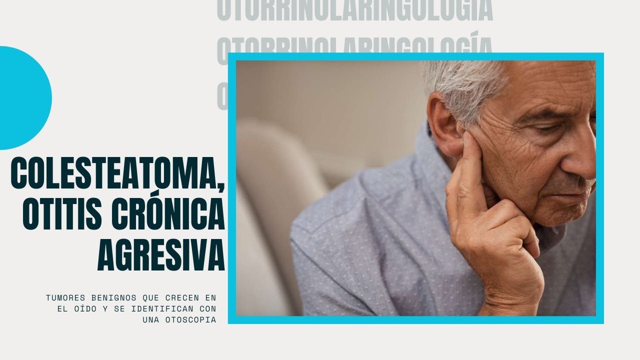 Colesteatoma, ¡una otitis crónica muy agresiva! - YouTube