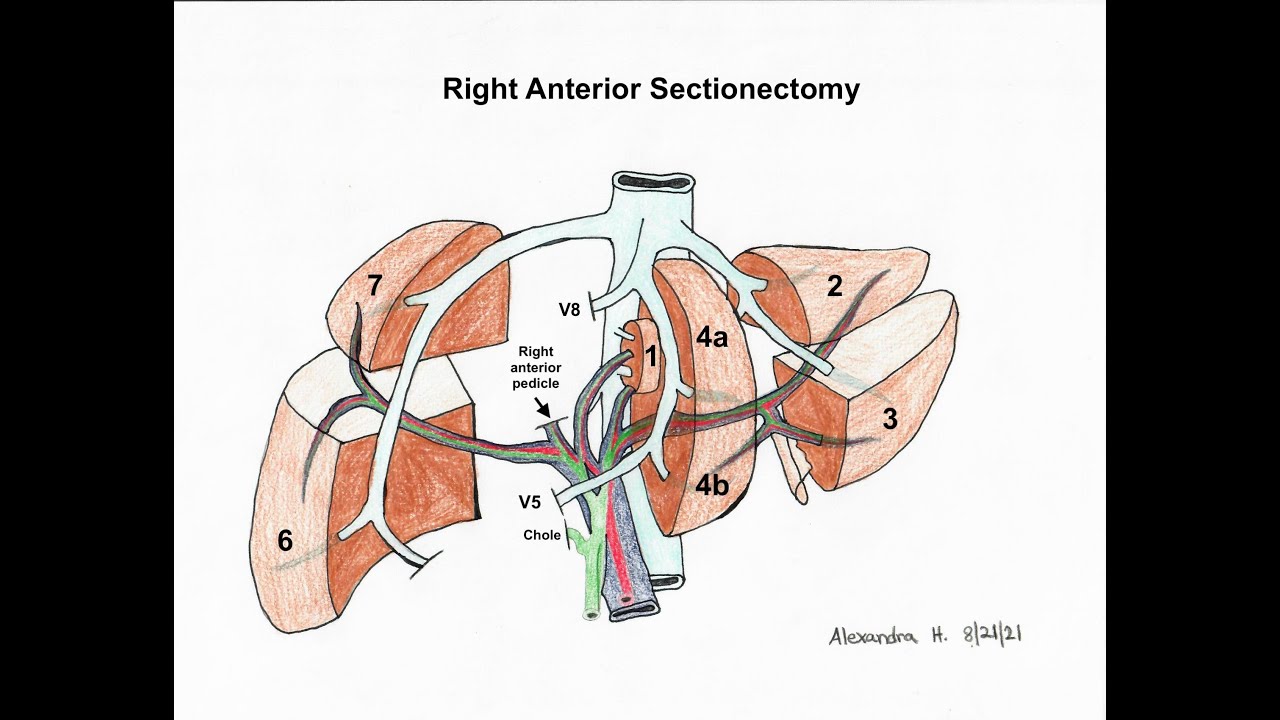 Robotic right anterior sectionectomy for HCC in a cirrhotic patient ...